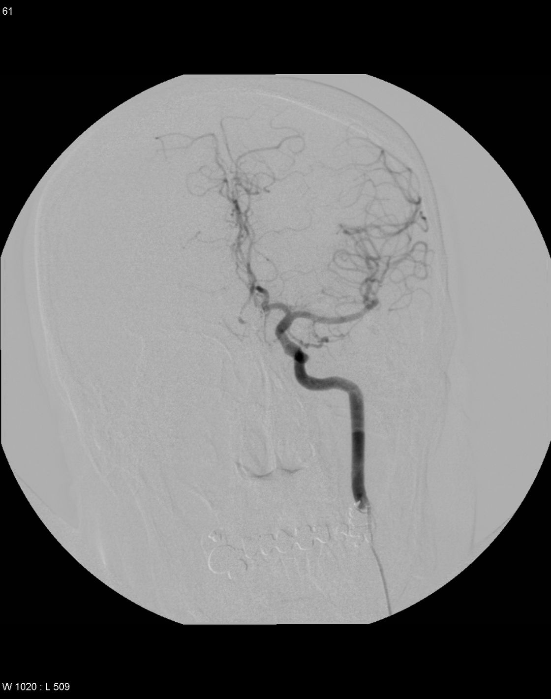 Angiographie und Interventionen | Universitätsklinikum Ulm