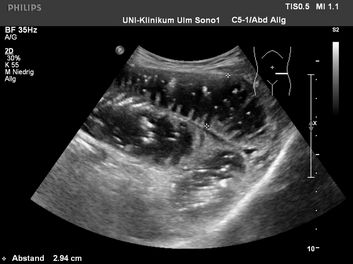 Ultraschall des Darms | Universitätsklinikum Ulm